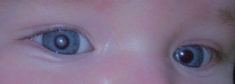 Childhood Cataract Research | Western Sydney University